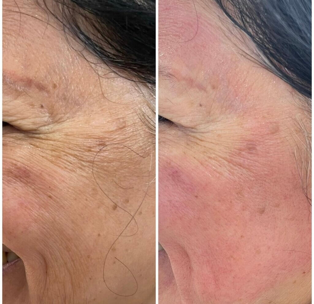 Microneedling Treatment In East Northport, NY | Dark Spots